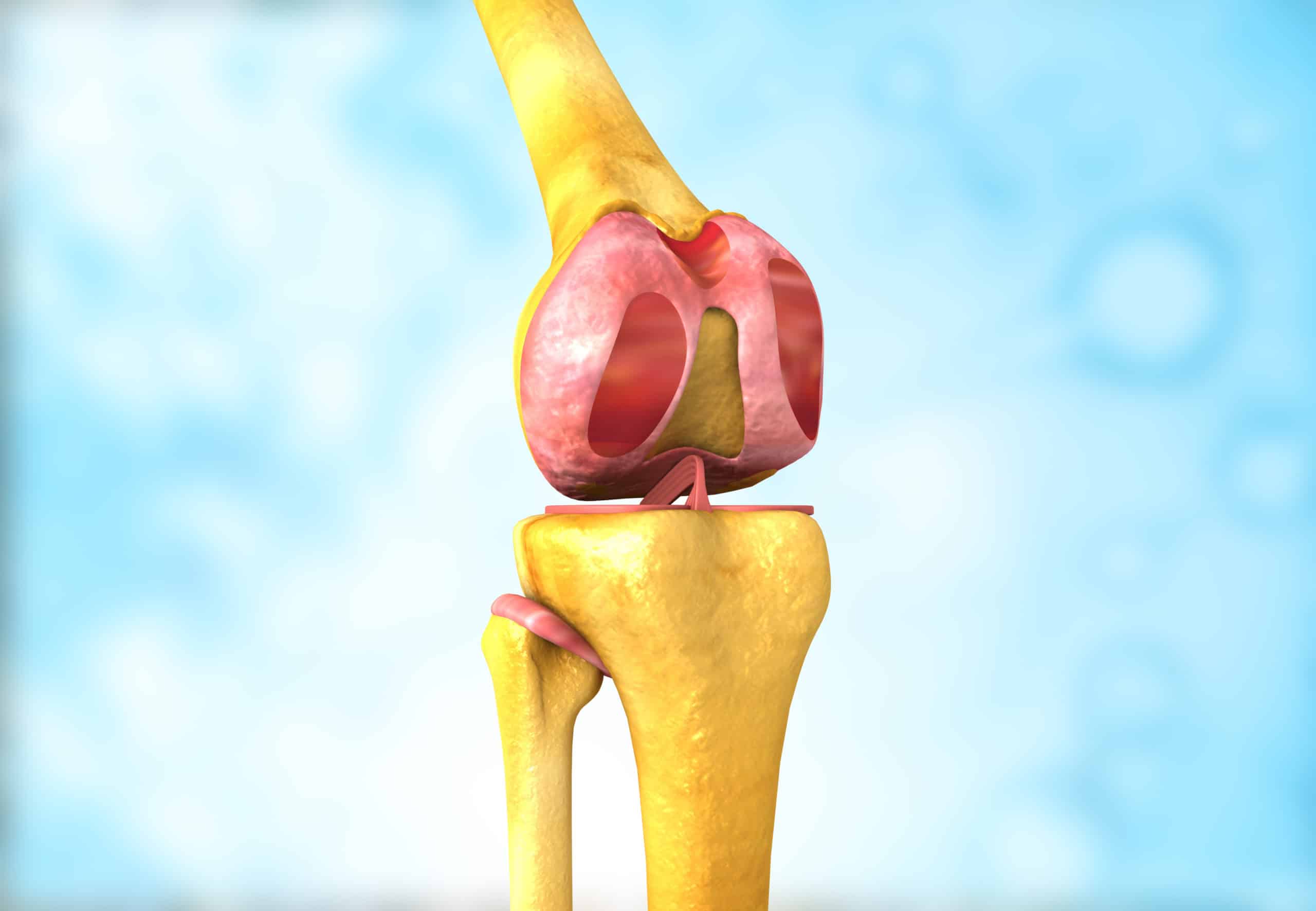 DePuy Knee Replacement Lawsuit - Sigma Knee Complications