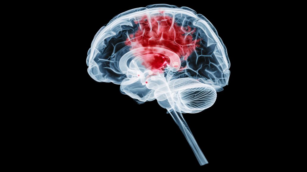 Leqembi Brain Bleeding & Swelling Lawsuit - Seeger Weiss LLP